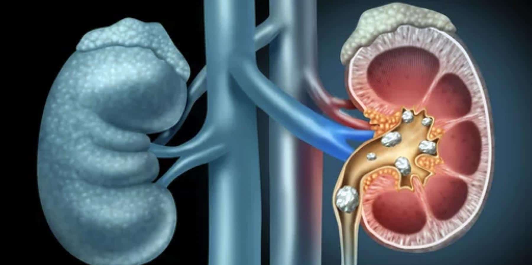 Managing Kidney Stones | Dispensaries